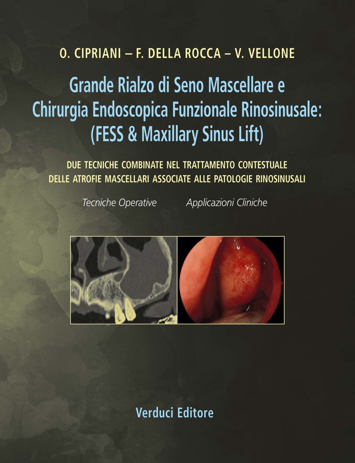 Grande Rialzo di Seno Mascellare e Chirurgia Endoscopica Funzionale ...